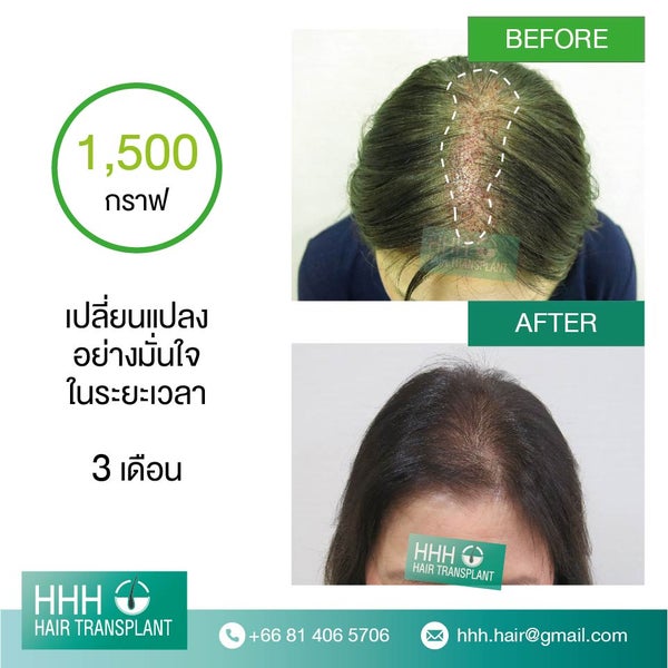 HHH Hair Transplant - วัฒนา - พระนคร, กรุงเทพมหานคร
