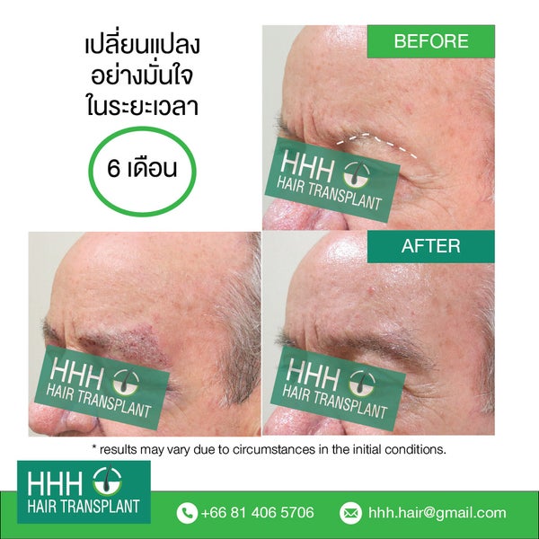HHH Hair Transplant - วัฒนา - พระนคร, กรุงเทพมหานคร